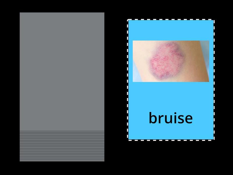 Unit 10: Sports Injuries - Speaking cards