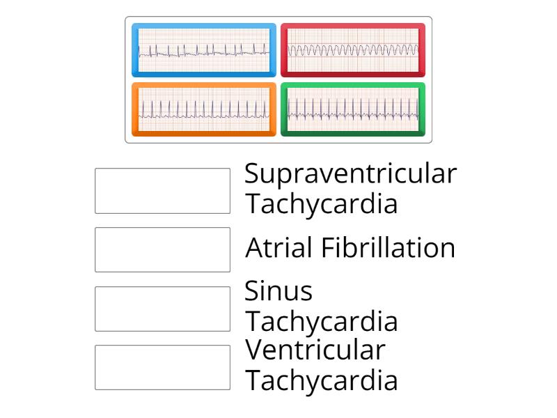 EKG - Match up