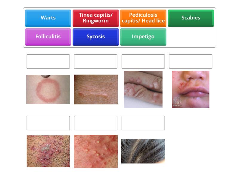Examples of absolute contra-indications (contagious hair and skin ...