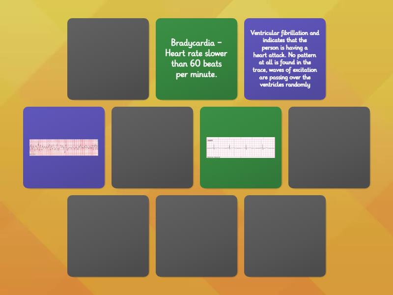 Electrocardiogram - ECG - Matching pairs