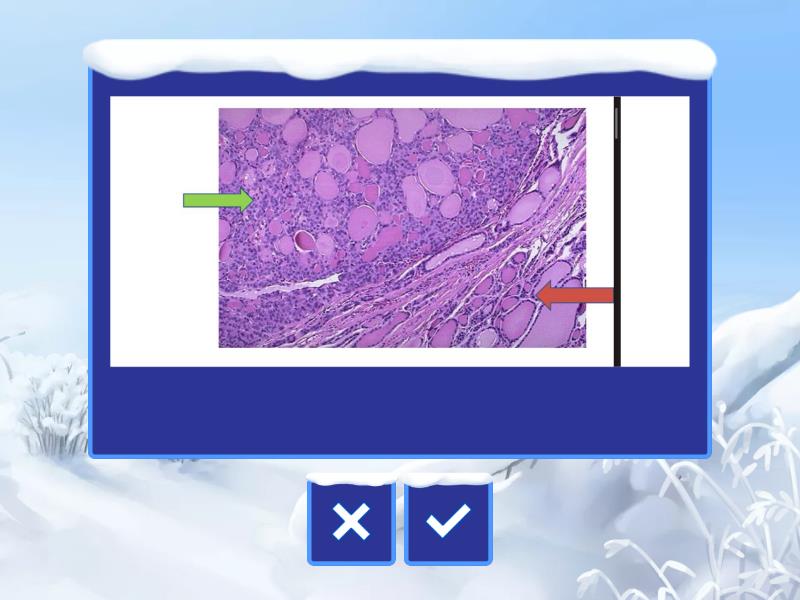 endocrine patho flashcards - Flash cards
