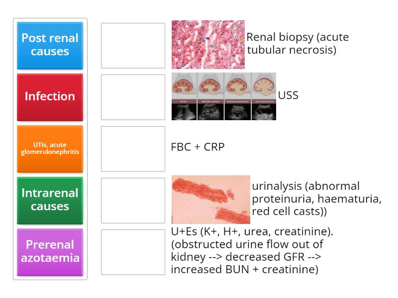 Causes and Investigations of AKI - Match up