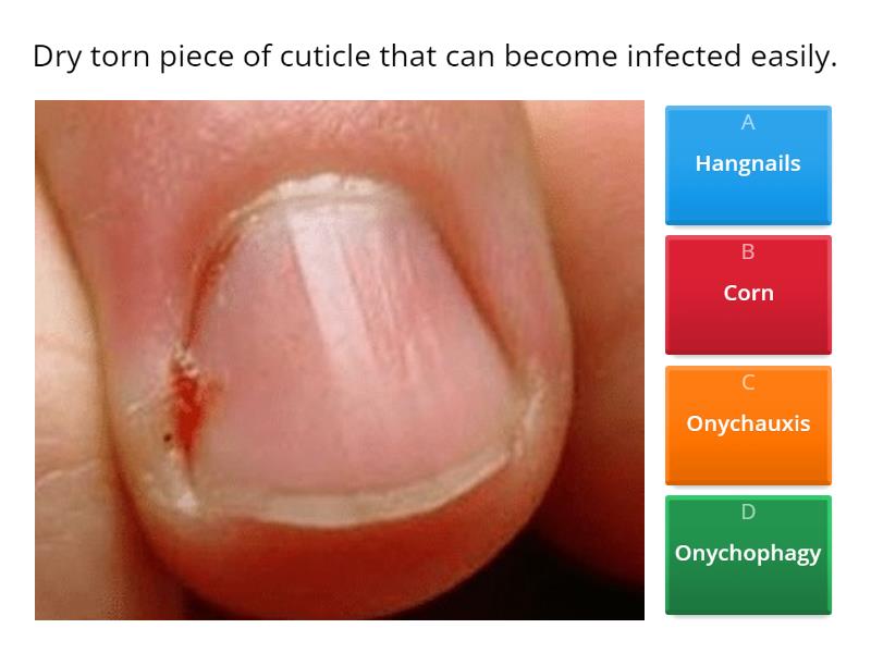 Manicure & Pedicure - Common Conditions - Quiz