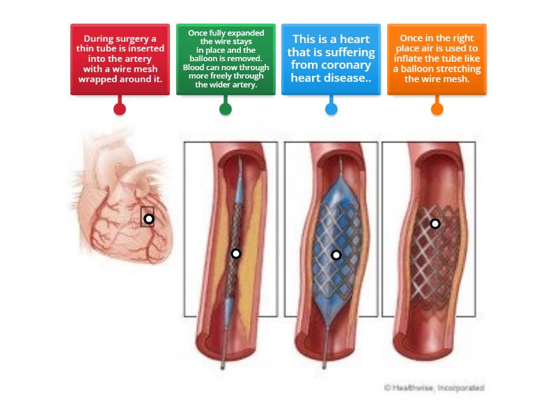 How does a stent work? - Labelled diagram
