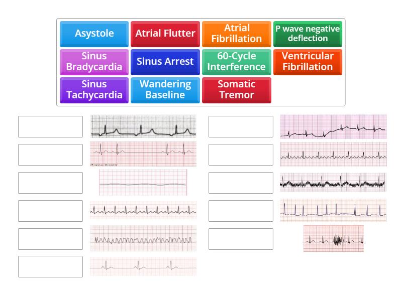 ECG Rhythms & Artifacts Matching - Match up