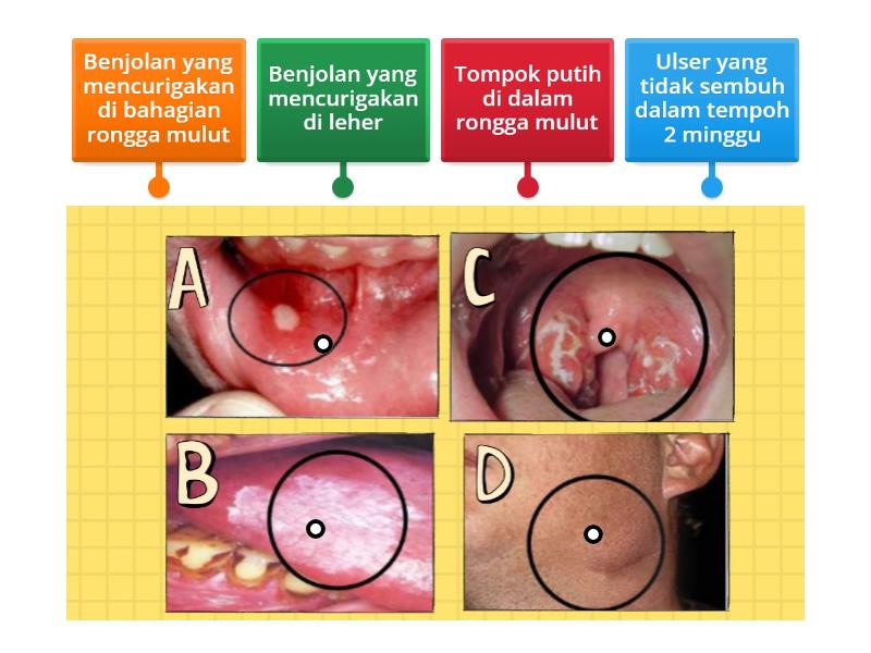 Padankan Tanda-tanda Lesi Pra-kanser - Labelled diagram